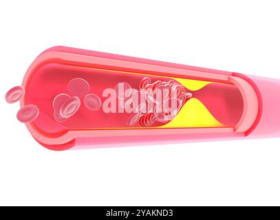 3d illustration of the anatomical interior of an artery. Obstructed by ...