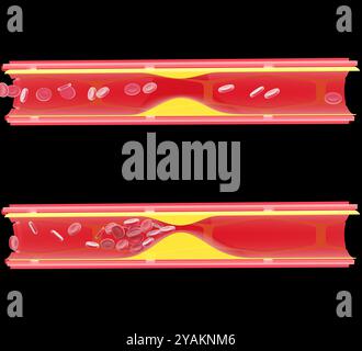 Anatomical 3D illustration of the interior of an artery obstructed by ...