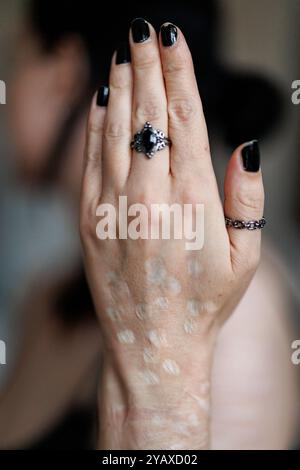 Cigarette burn scars in self-harm. Close-up of old scars left from ...