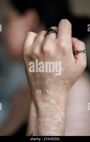 Cigarette burn scars in self-harm. Close-up of old scars left from ...