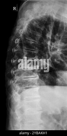 X-ray of thoracic spine. Lateral view. Vertebrae and intervertebral ...