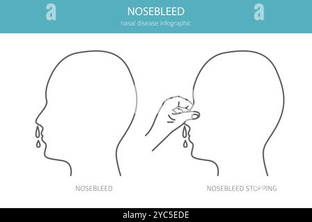 Nosebleed. Nasal diseases. Medical infographic design. Vector illustration Stock Vector Image ...
