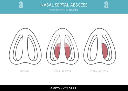 Nasal septal abscess. Nasal diseases. Medical infographic design ...