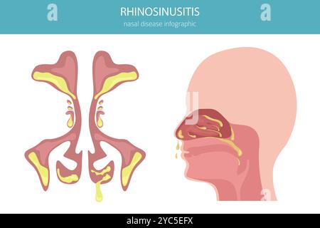 Rhinosinusitis. Nasal diseases. Sinusitis, sinus infection diagnosis ...