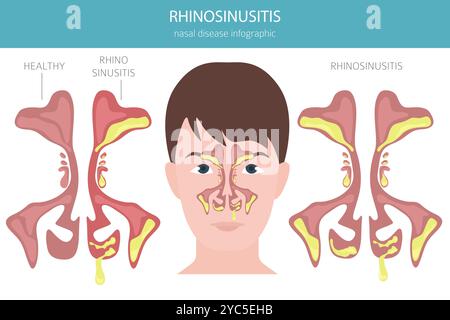 Rhinosinusitis. Nasal diseases. Sinusitis, sinus infection diagnosis and treatment medical ...