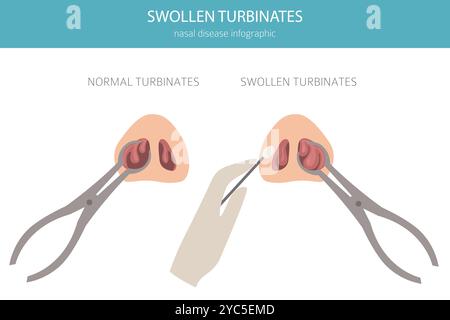 Swollen turbinates. Nasal diseases. Medical infographic design. Vector ...