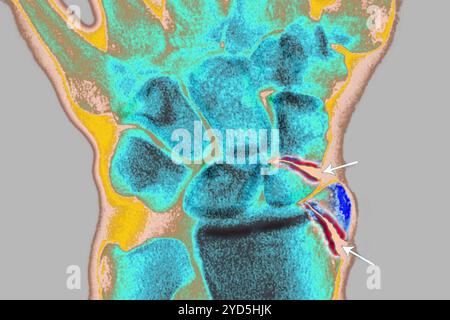 Wrist fracture (scaphoid and radius). X-ray of the wrist of a right ...