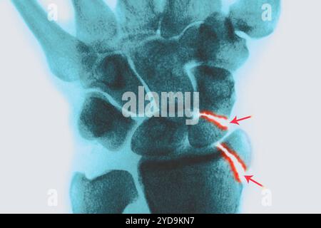 Wrist fracture (scaphoid and radius). X-ray of the wrist of a right ...