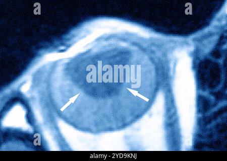 Retinal detachment occurs when the tissue at the back of the eye ...