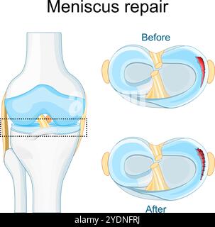 Meniscal tear. Knee anatomy. Close-up of Torn meniscus and cartilage ...