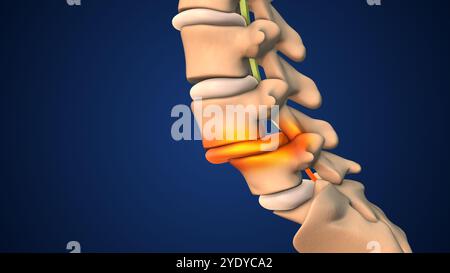 Spondylolisthesis Involving Vertebrae Shifting Out of Place Stock Photo ...
