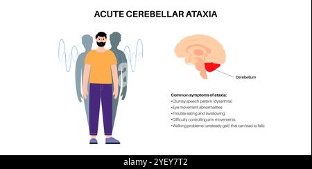 Conceptual illustration of cerebellar ataxia. Ataxia is disorder that ...