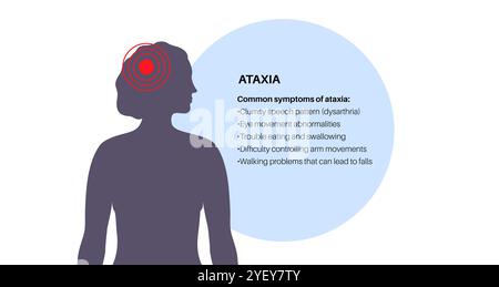 Conceptual illustration of cerebellar ataxia. Ataxia is disorder that ...