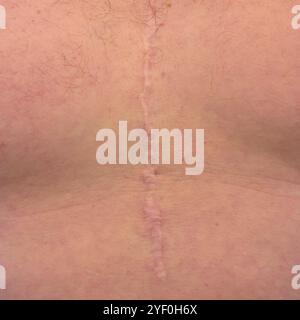 Scar from open heart surgery of coronary artery disease, where the ...