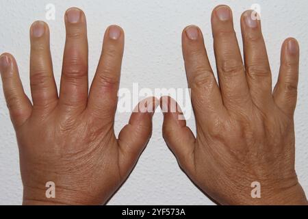 Swollen Hand After Insect Bite Stock Photo - Alamy