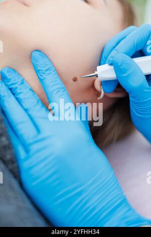 Procedure for laser removal of neoplasms on the face in a cosmetology ...