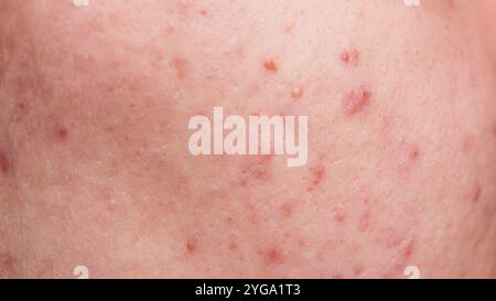 Many Pimples Bad Skin Hormonal Acne Puberty Skin Acne Background