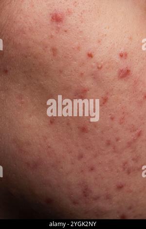Texture of skin with acne problem as background, macro view Stock Photo ...
