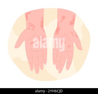 psoriasis,skin,body,chronic,allergy,eczema,stress,infection,itch ...