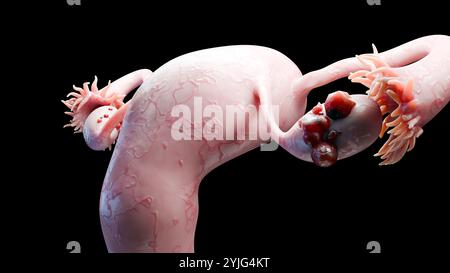 Ovarian malignant tumor, Female uterus anatomy, Reproductive system ...