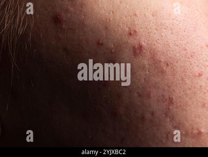 Dermatological acne. Skin texture background. Closeup acne pimple ...