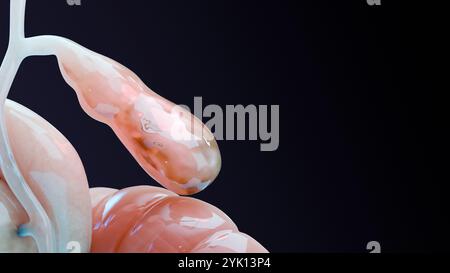 Gallstones in the gallbladderand bile duct, human silhouette and ...