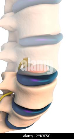 Slipped disk or a ruptured disk Stock Photo - Alamy