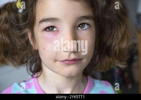 A red swollen eyelid on a child face in close-up is an allergy to an ...