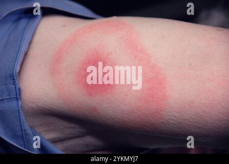 Bullseye rash linked to Lyme disease Stock Photo - Alamy