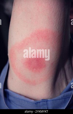 Bullseye rash linked to Lyme disease rotated Stock Photo - Alamy