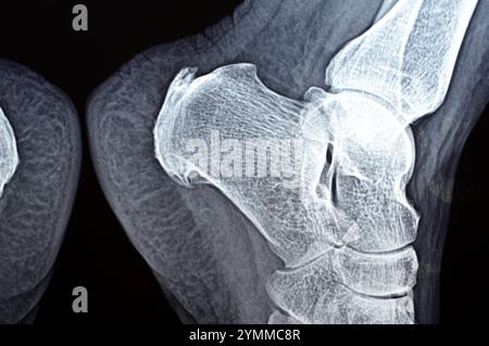 Plain X ray of female patient foot shows calcaneal heel spur, bony ...