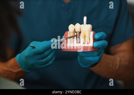 Plastic dental implant model for education patient Stock Photo - Alamy