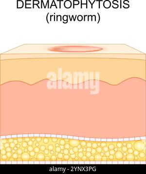 Pityriasis versicolor. fungal skin infection. Cross section of a human ...