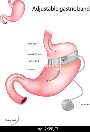 Illustration of gastric banding. A laparoscopic adjustable gastric band ...