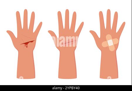 Bleeding cut on the palm, emergency situation. First aid treatment for ...