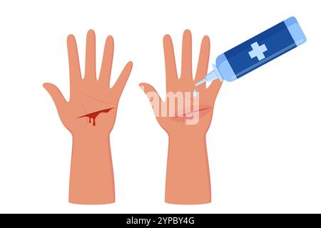 Bleeding cut on the palm, emergency situation. First aid treatment for ...