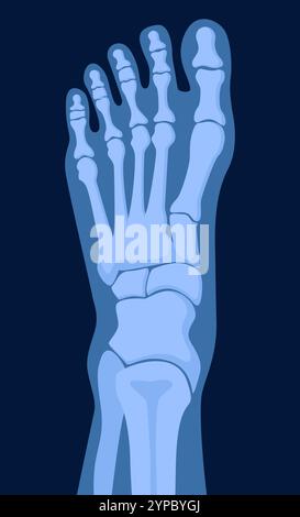 X ray human foot. X-ray picture or radiographic monitor image of ...
