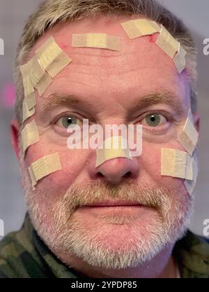 MODEL RELEASED. Basal cell carcinoma (BCC), or rodent ulcer, on a ...