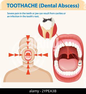 Illustration of toothache causes and symptoms Stock Vector Image & Art ...