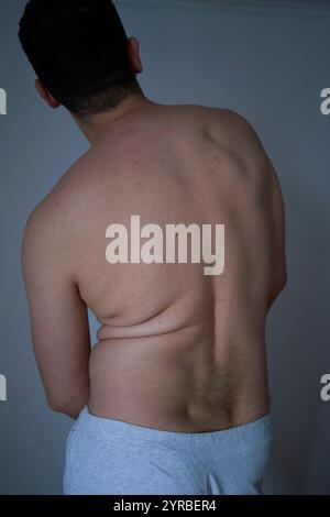 young man with a crooked spine, scoliosis, shoulders at different ...