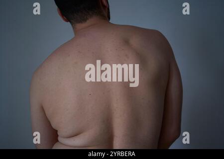young man with a crooked spine, scoliosis, shoulders at different ...
