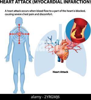 Illustration of heart attack symptoms and causes Stock Vector Image ...