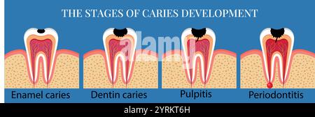 Caries development. Dental disease stages: enamel and dentin caries ...