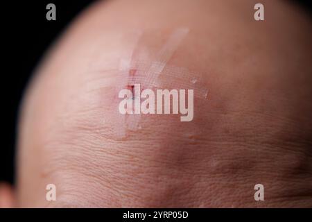 Head injury hematoma and cut. Concussion tbi injury Stock Photo - Alamy