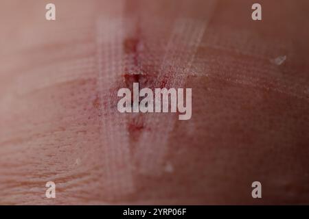 Head injury hematoma and cut. Concussion tbi injury Stock Photo - Alamy