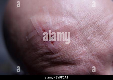 Head injury hematoma and cut. Concussion tbi injury Stock Photo - Alamy