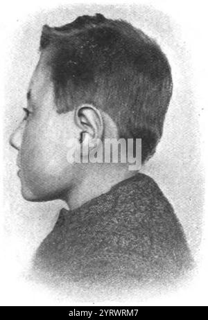 Coats Oxycephaly 2 Stock Photo - Alamy