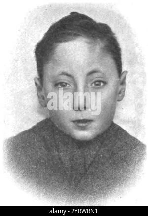 Coats Oxycephaly 1 Stock Photo - Alamy