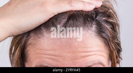 Close-up of female pattern baldness, showing thinning hair and receding ...