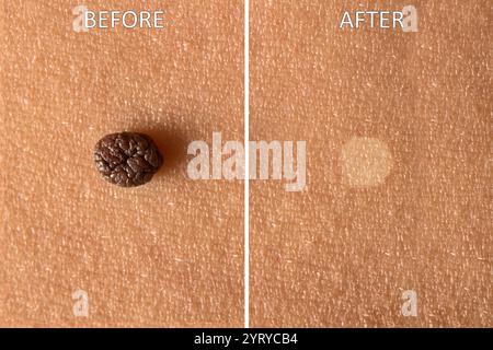 Skin tag removal before and after procedure showing the scar and ...